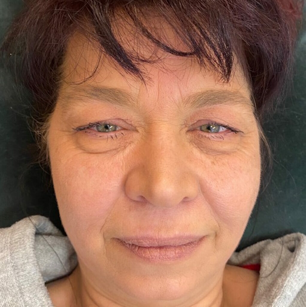 Augenringe - Perfect Skin Berlin