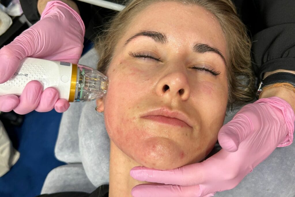 Radiofrequenz Microneedling - Top-Beautybehandlung | Perfect Skin Berlin