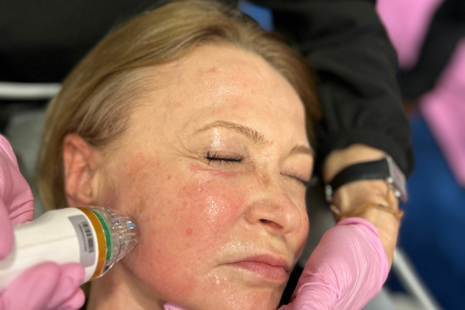 Radiofrequenz Microneedling - Top-Beautybehandlung | Perfect Skin Berlin